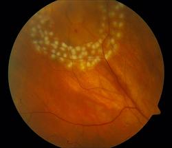 Die Netzhautlöcher & Netzhautablösung