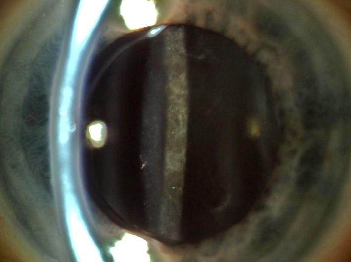 Der graue Star (Katarakt) & Nachstar